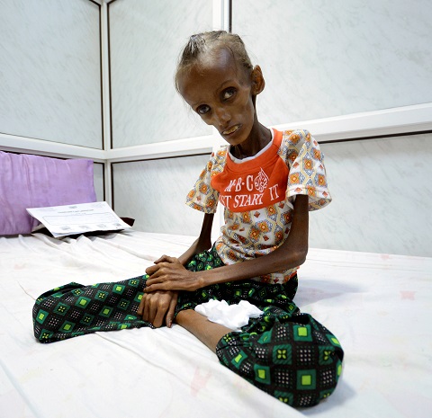 A picture and its story: severe malnutrition in Yemen • INSP News Service
